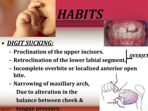 Treatment Of Class Ii Malocclusions Pptx