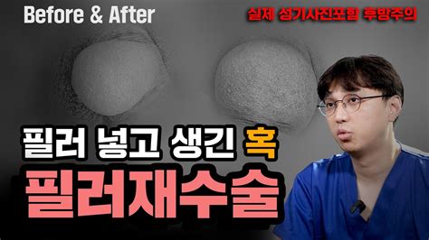 후방주의 실제 성기 사진으로 보는 필러 재수술 Youtube