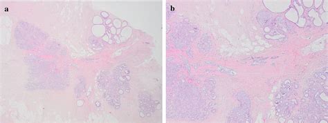 A Histology Features Of A Benign Radial Scar At Low Power View B Download Scientific Diagram