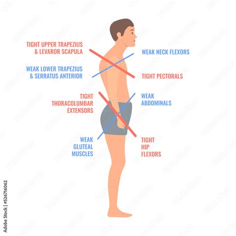 Vektorová Grafika „upper And Lower Crossed Syndrome Medical Diagram