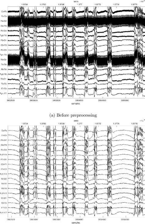 Figure 21 From Investigating Eeg Burst Suppression For Coma Outcome Prediction Semantic Scholar