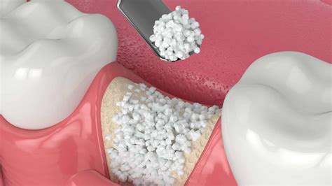 Bone Graft Post Operative Instructions Atlas Dental