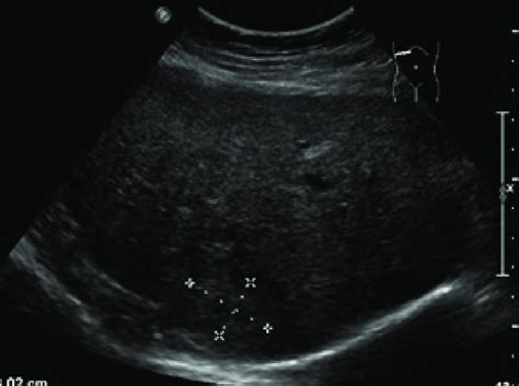 Uss Showing Ill Defined Hyperechoic Nodule Marked In Hepatic Segment