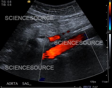 Photograph Normal Aorta Ultrasound Science Source Images
