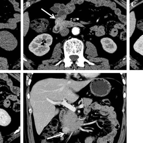 Ct Images In A 69 Year Old Woman With Duodenal Gists A Unenhanced Download Scientific Diagram