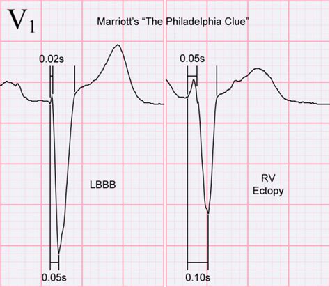 Left Anterior Hemiblock Ecg Guru Instructor Resources