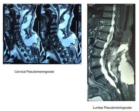 Addressing Dural Tears In Lumbar Spine Surgery