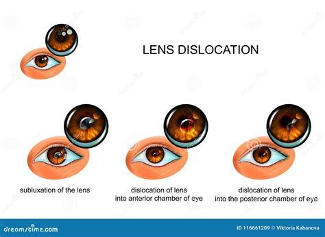 Dislocation Of The Lens Of The Eye Stock Vector Illustration Of Iris