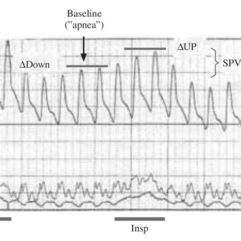 A Inferior Vena Cava Ivc Poor Distensibility Divc Low Predicts No Download Scientific