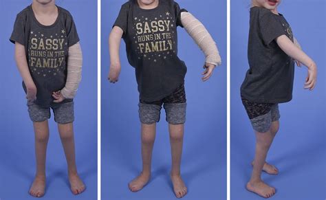 Using Telerehabilitation To Deliver A Home Exercise Program To Youth With Arthrogryposis Single