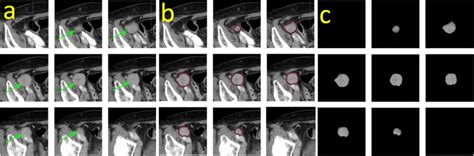 An Illustration Of Tumor Segmentation By Outlining Its Boundary Download Scientific Diagram