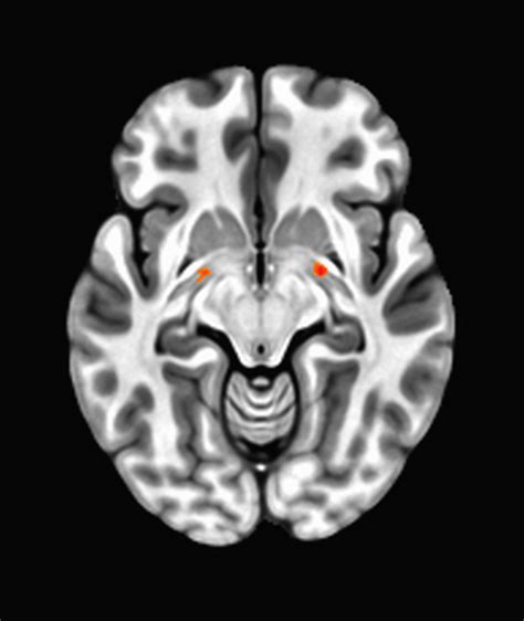 Nucleus Basalis Of Meynert Afni Message Board Afni Discuss Message