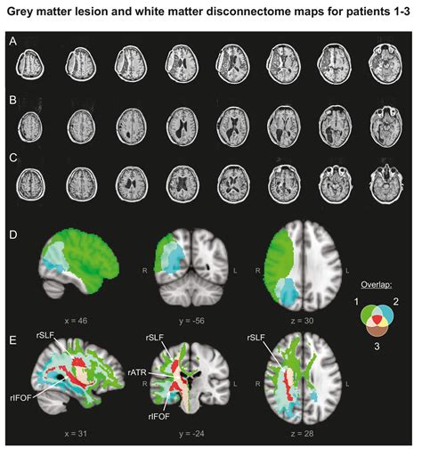 Induced Sensorimotor Cortex Plasticity Remediates Chronic Treatment