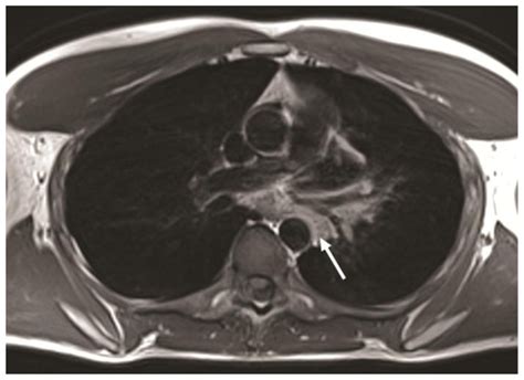 A Complex Pulmonary Vein Varix Diagnosis With Ecg Gated Mdct Mri And Invasive Pulmonary