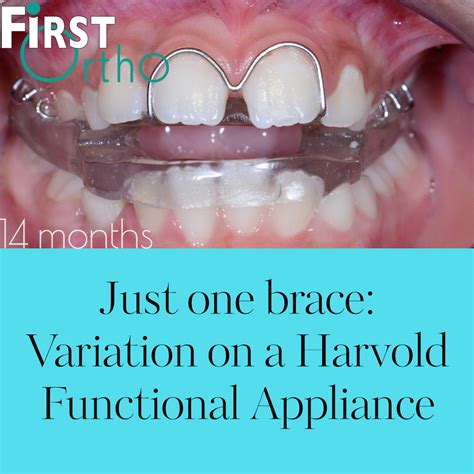 Teeth Sticking Out In A Young Girl First Ortho