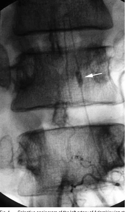 Figure 1 From Subarachnoid Hemorrhage Due To Isolated Spinal Artery Aneurysm In Four Patients