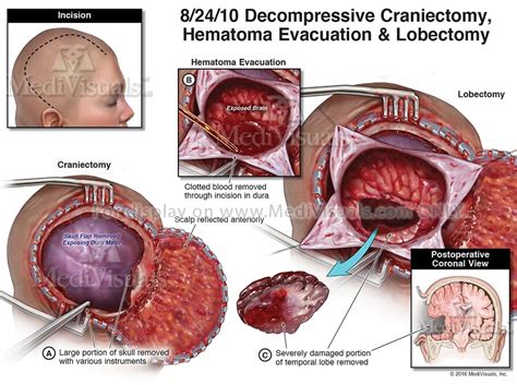 Decompressive Craniectomy Hematoma Evacuation And Lobectomy Medivisuals High Impact