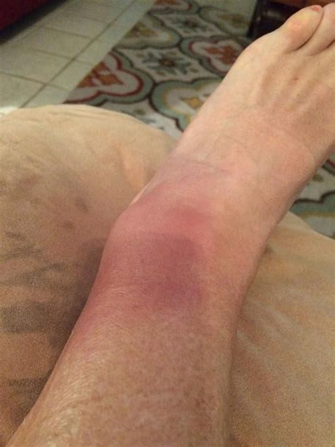 Is Your Ankle Broken Or Sprained