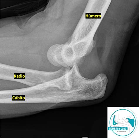 Luxación Del Codo Causas Síntomas Y Opciones De Tratamiento