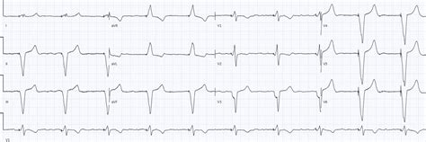 Pacer Mnemonic Approach To Pacemaker Patients Ecg Cases Em Cases
