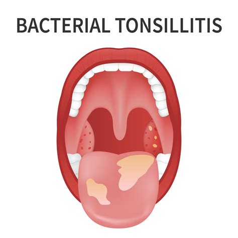 Inflamed Tonsils Tonsillitis In Women Khlje