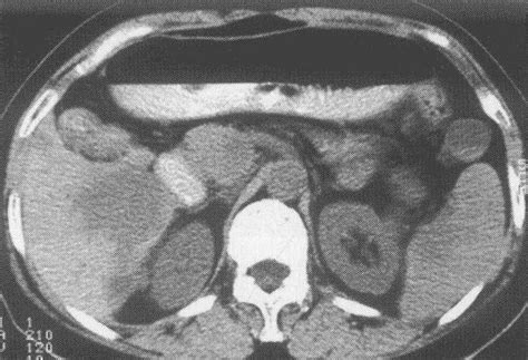例7 肝、脾转移瘤 Ct读片指南