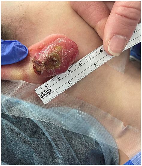 A Rare Report Of Proliferative Fasciitis Of The Ear In A Pediatric Patient Ruthann I Lipman