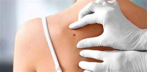 Integumentary System Quiz Questions And Answers Attempts 41571