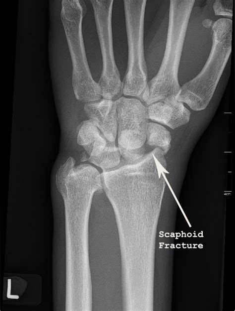Scaphoid Fracture X Ray At Rebecca Rodriguez Blog