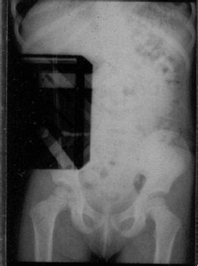 Artifacts And Misadventures In Digital Radiography Applied Radiology