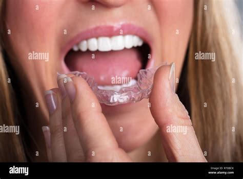 Woman Wearing Clear Aligner Stock Photo Alamy