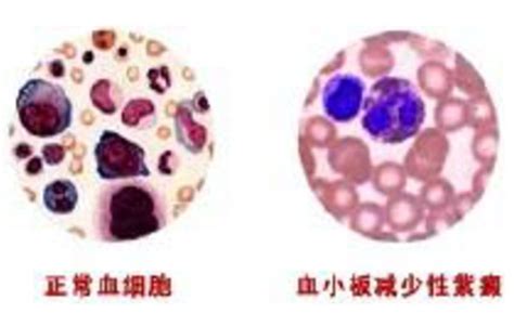血小板减少性紫癜在临床的常见表现特征 病症知识 轻壹