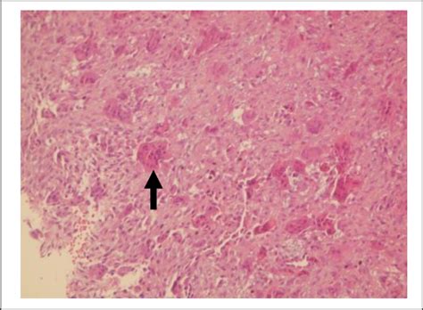 Multinucleated Giant Cells And Spindle Shaped Fibroblasts In A High Download Scientific Diagram