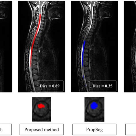 Example Of Deepseg Segmentation Zones Of The Missing Slices Are Download Scientific Diagram