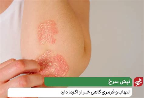 درمان خشکی پوست 10درمان خانگی سدی محکم در مقابل باکتری‌ها