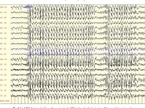 Figure 2 From Eeg Fmri As An Useful Tool To Detect Epileptic Foci