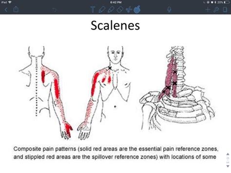 Scalenes Trigger Points