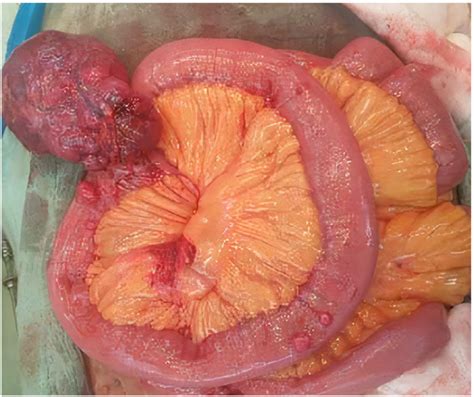Intra Op Findings 6 7 Cm Oval Mass Located In The Antimesenteric