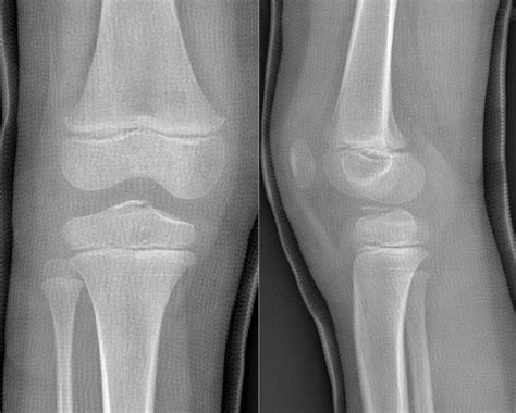 Defining The Boundaries Of Surgery In Pediatric Acl Avulsion Fractures