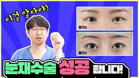 이걸 알아야 눈재수술 성공합니다 쌍꺼풀 수술 후 재수술 하는 이유가 궁금하다면 Youtube