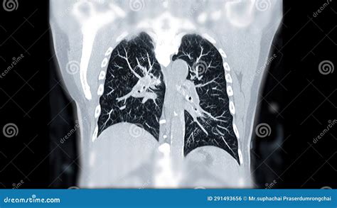 Lung Diagnostic Scared Radiologist Chest X Ray Stock Image 217853401
