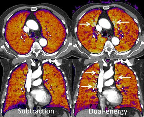 Imaging Of Pulmonary Perfusion Using Subtraction Ct Angiography Is Feasible In Clinical Practice