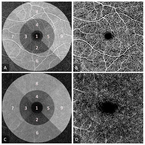 Calculation Of Vessel Density Vd In The Superficial Vascular Plexus Download Scientific