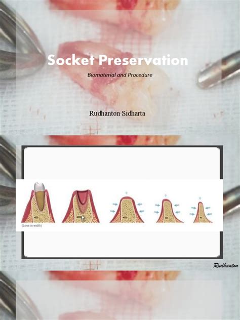 Socket Preservation Procedure Ii Pdf Osteoblast Clinical Medicine