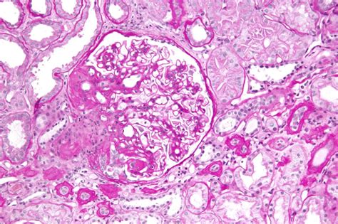 50 Facts About Glomerulosclerosis