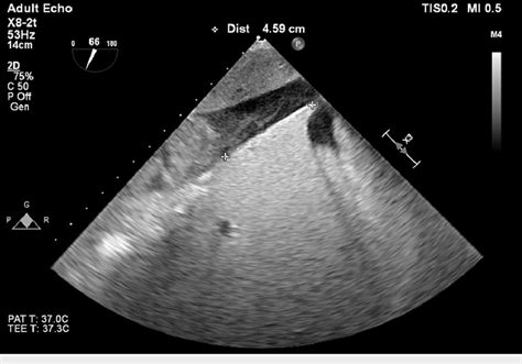 Intraoperative Tee Demonstrating Ivc Thrombus With Liver In Long Axis