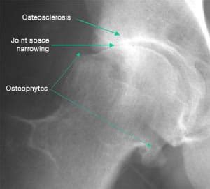 Osteophytes X Ray