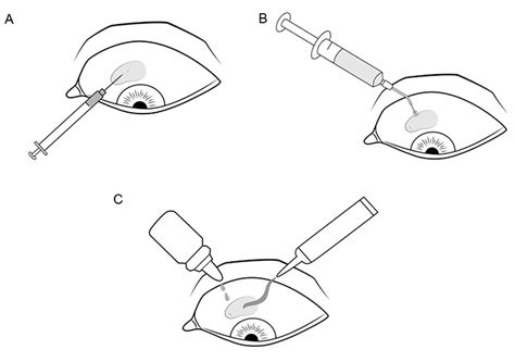 An Easy And Safe Method Of Subconjunctival Injection Of Antimetabolites