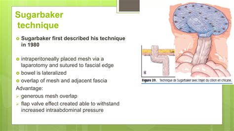Parastomal Hernia Pptx