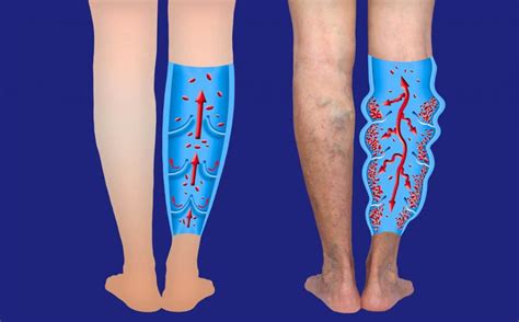 What You Need To Know About Venous Insufficiency Integrative Wellness